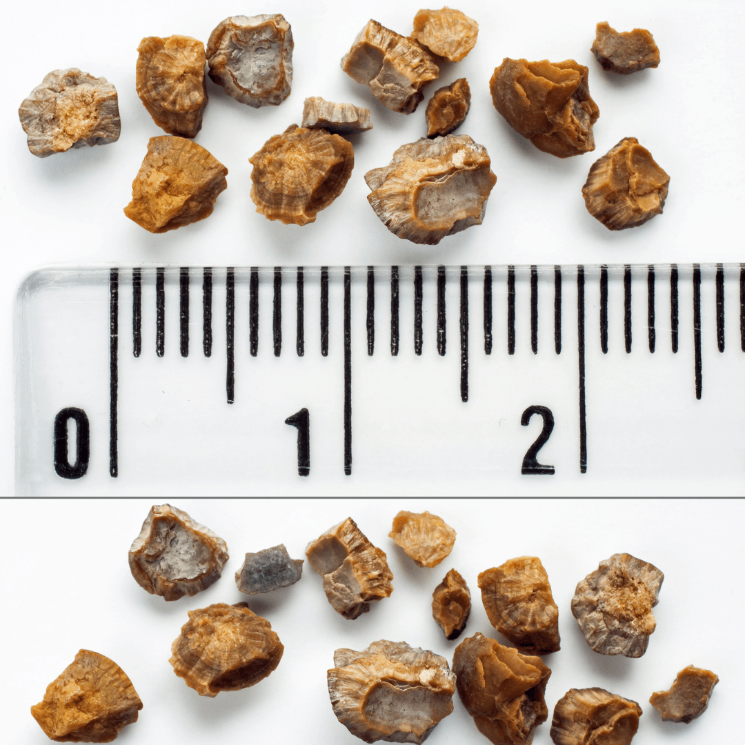 Kidney Stones: From Formation to Treatment and Beyond | Ulta Lab Tests