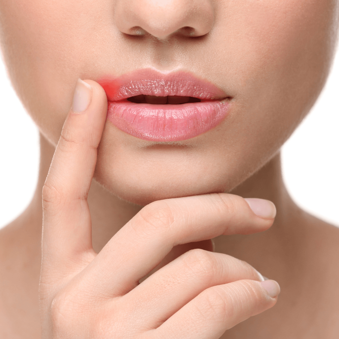 Cold Sores Explained: Is it Herpes on Your Lip | Ulta Lab Tests